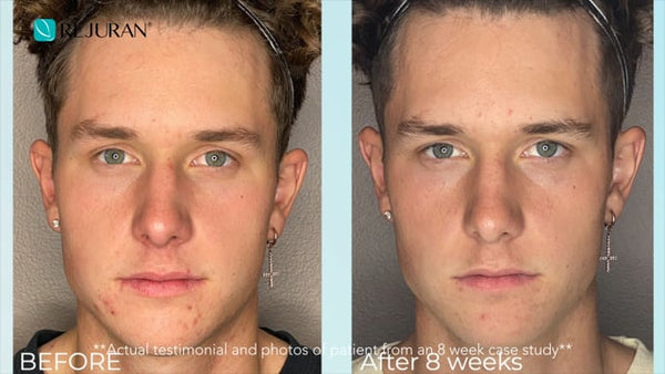 Advanced Scar Gel | Acne Scar Treatment | Rejuran